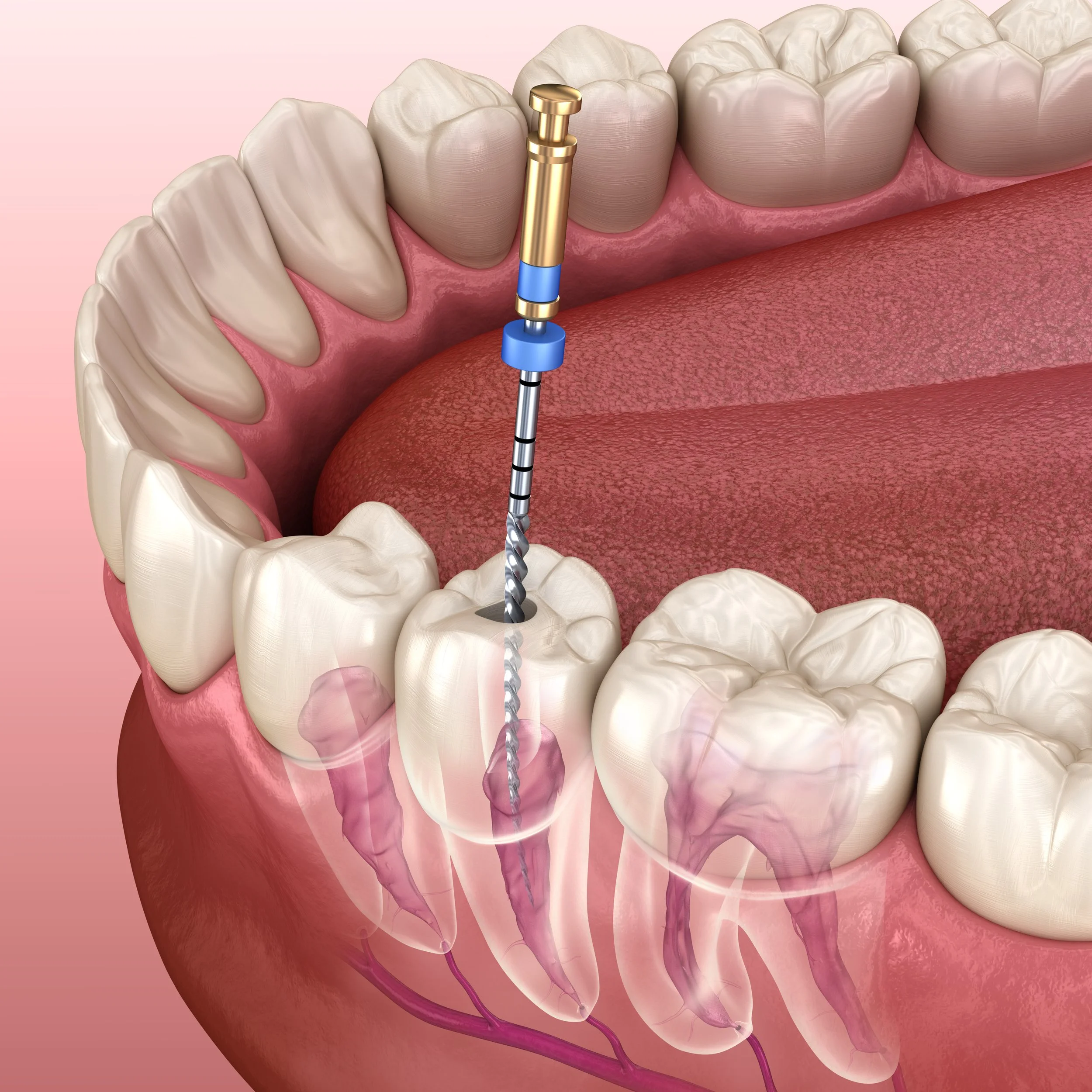 Root Canal Treatment Kozhikode | Painless RCT Specialists
